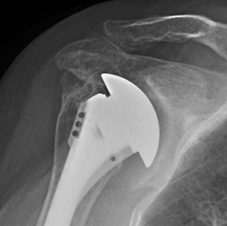 Shoulder Arthritis/Joint Replacement Rotator cuff tears ...