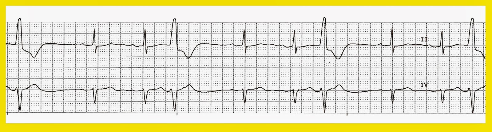 EKG Rhythm Quiz 219