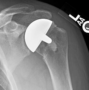 UW Shoulder and Elbow Academy: Innovations in shoulder arthroplasty ...