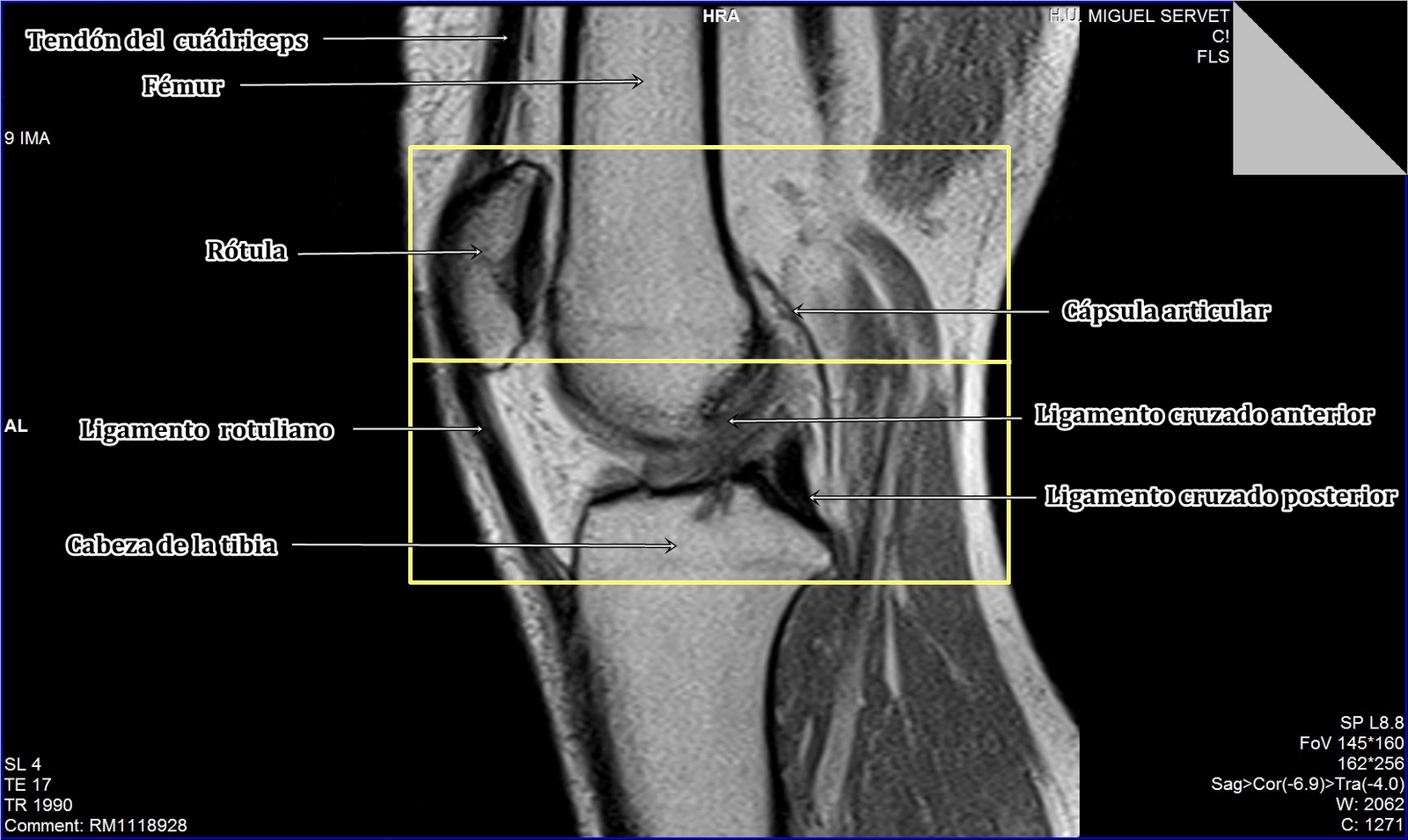 Protocolo de Rodilla por RM
