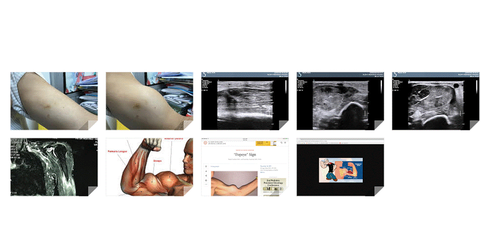 VIETNAMESE MEDIC ULTRASOUND: CASE 478: POPEYE’ SIGN of BICEPS MUSCLE ...