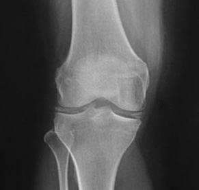 metabo's kuwento: Pseudogout(CPPD)