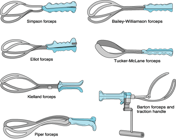 học Y: forceps - ventouse