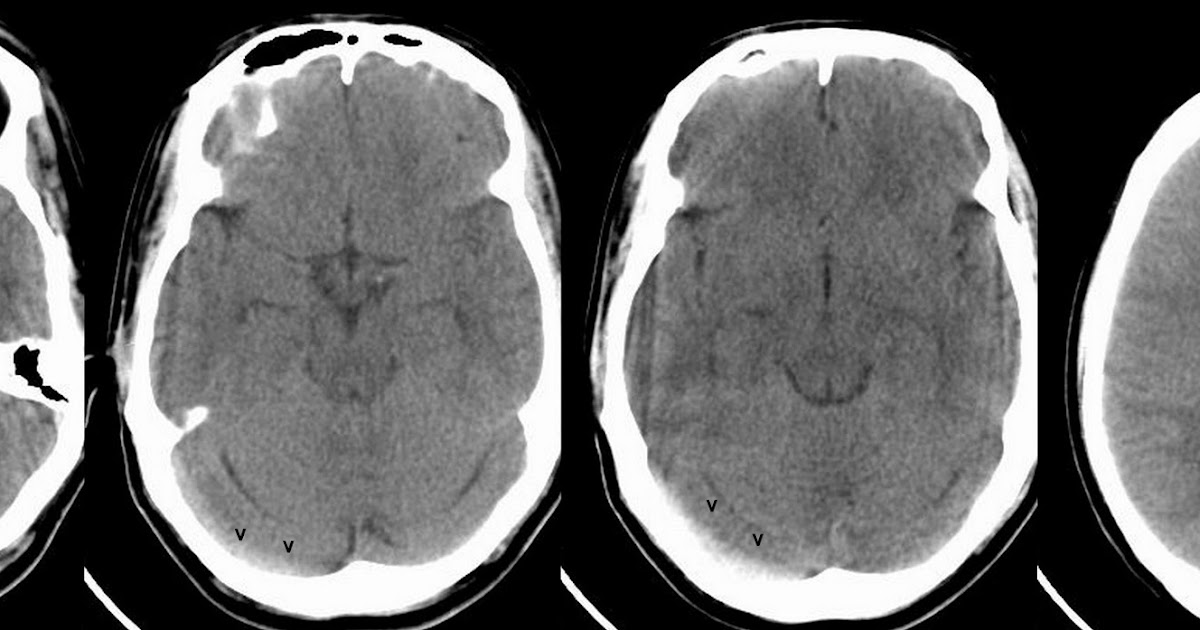 Dr Balaji Anvekar FRCR: Hyperdense dural venous sinuses on CT