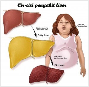 Tips dan Cara Mencegah Liver Kambuh Lagi