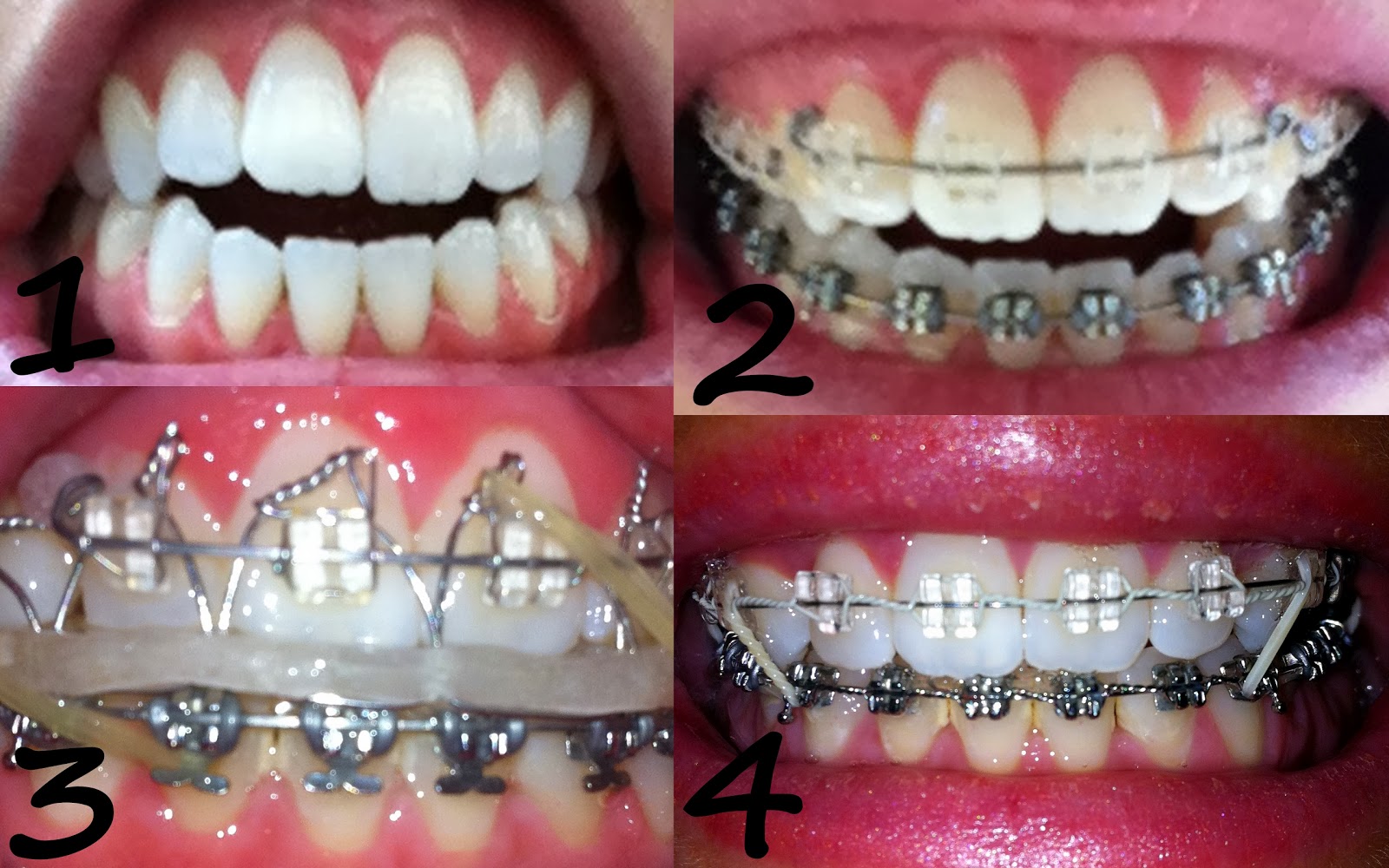 my jaw's journey: braces, surgery and everything in between!: before ...