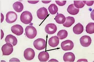 Fichero de Hematología: Anormalidades Eritrositarias.