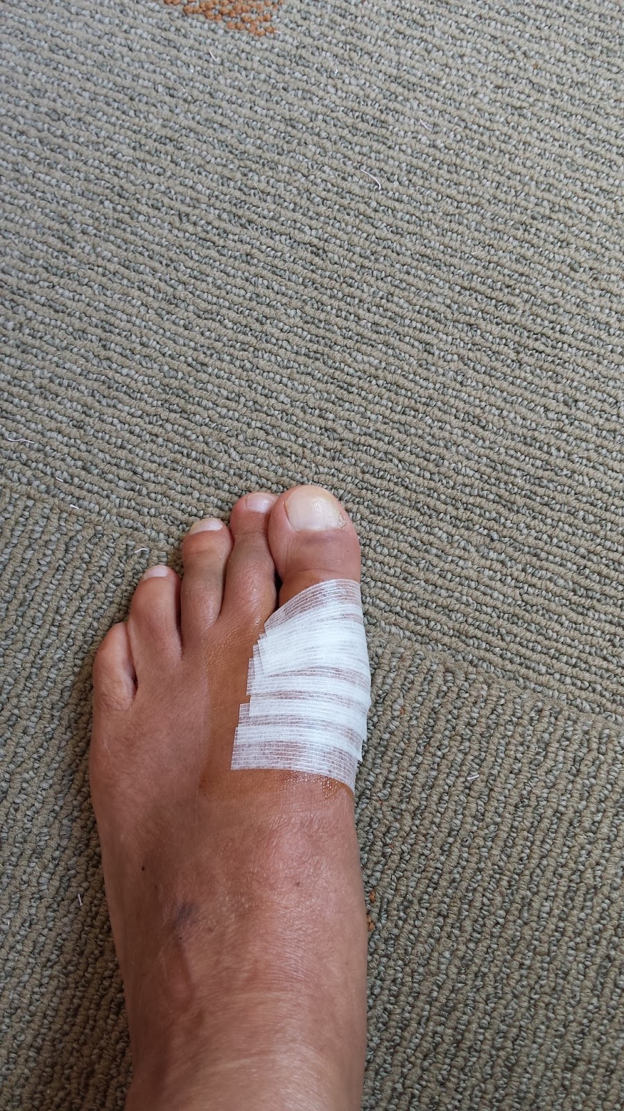 My Cheilectomy Journal: Day 13--Stitches out and boot off!