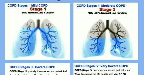 Medical and Health Science: Stages of COPD!!!