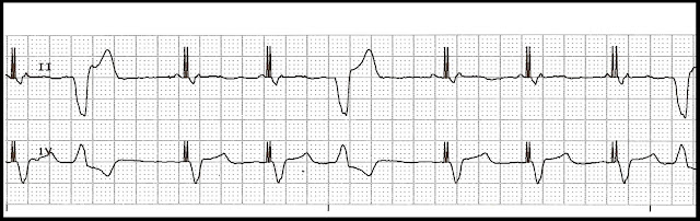 EKG Quiz 324