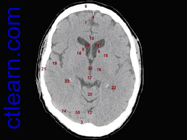Anatomy CT Axial Brain