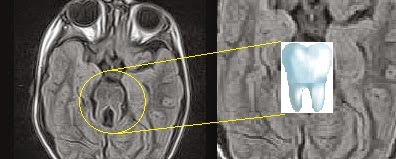 POINT OF VIEW: DX: Joubert Syndrome