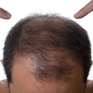 Facts on balding men's Hairsyles | Tips Hair Style