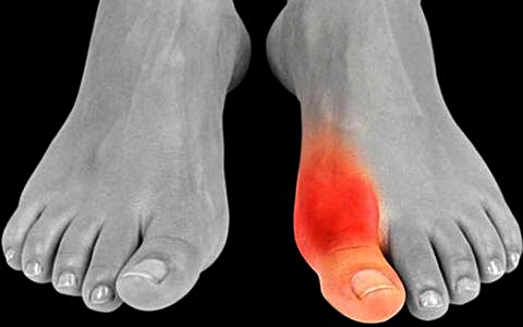 DESI M.B.: ¿HAS PADECIDO LA GOTA?