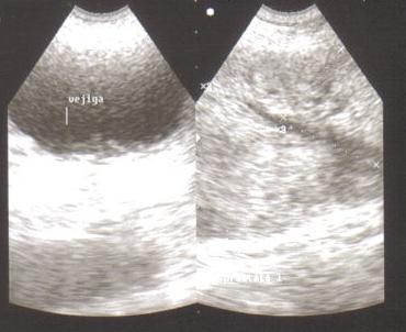 enfermedadesinfecciosasFCV-UBA: Prostatitis bacteriana aguda en un ...