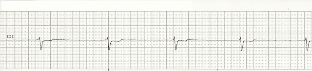 Float Nurse: Beta blocker toxicity