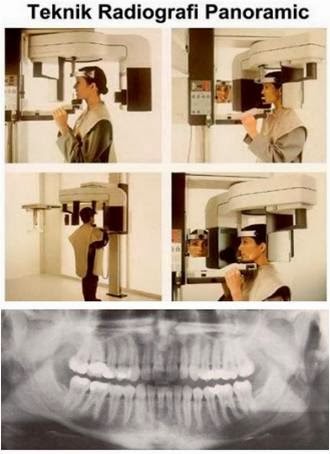 Teknik Radiografi Dental ~ Dent-ias || notes