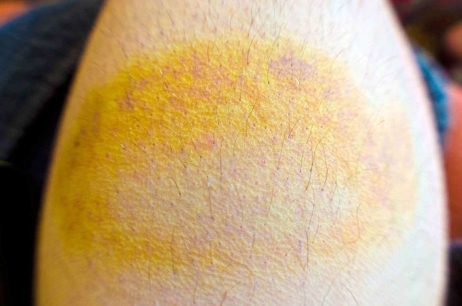 Whimsy: The bruise on my thigh