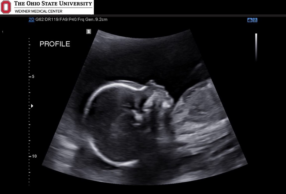 BARNETT BABY: 18 WEEK ULTRASOUND!!!