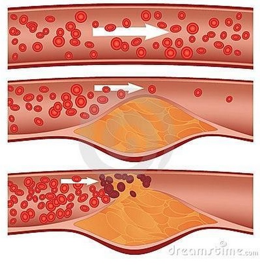 Actividad fisica, Nutricion y Salud: ¿QUÉ SON LOS TRIGLICÉRIDOS?
