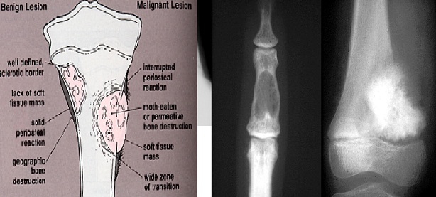 Dr Herry Setya Yudha Utama SpB. FInaCS. MHKes. ICS: Malignant Bone ...