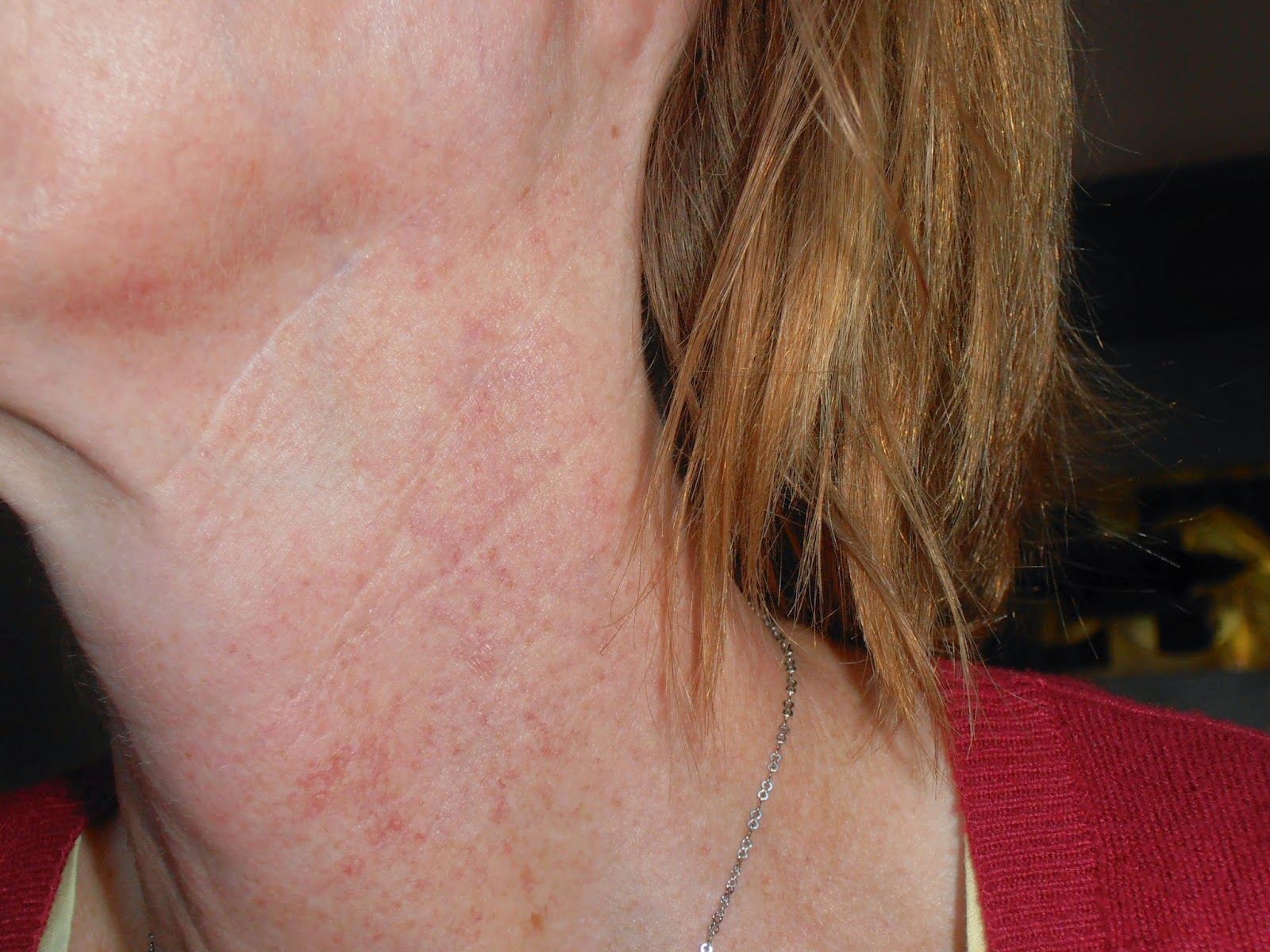 Living with Scleroderma in Australia