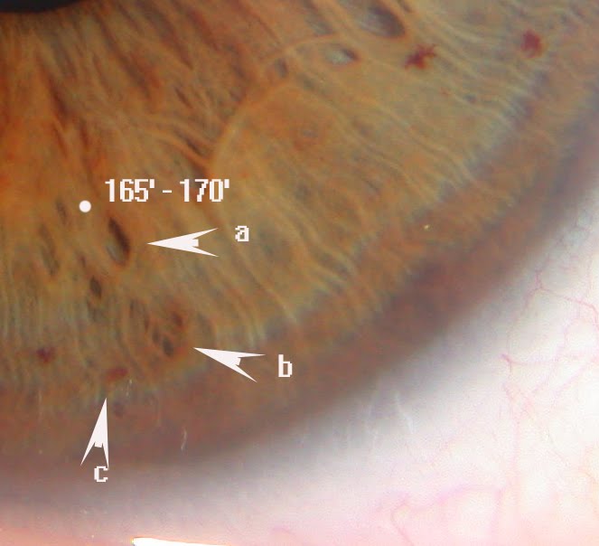 Modern & Multidimensional Iridology: Stairstep Lacuna with Combination ...