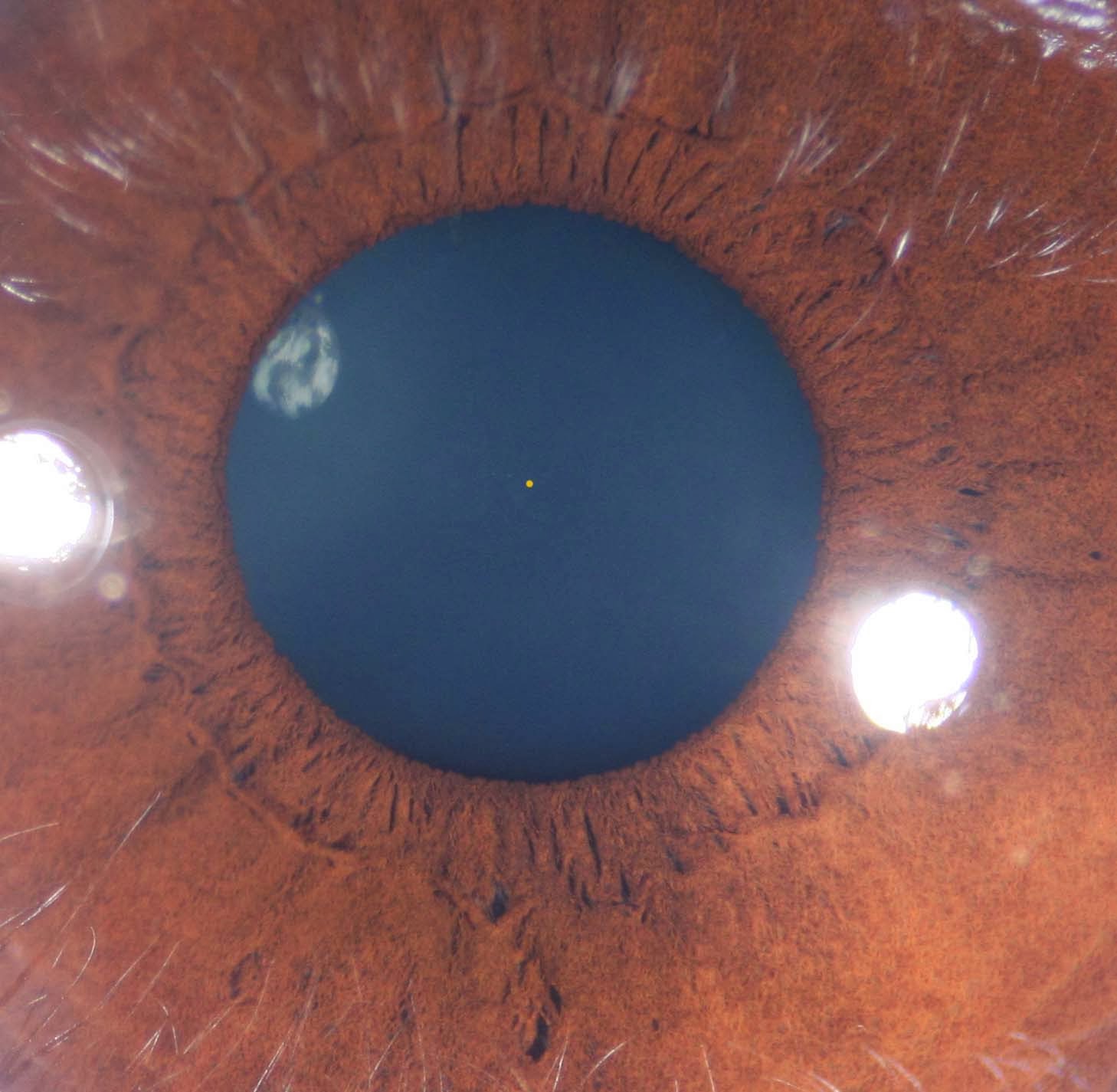 Modern & Multidimensional Iridology: The Importance Iris Signs at ...