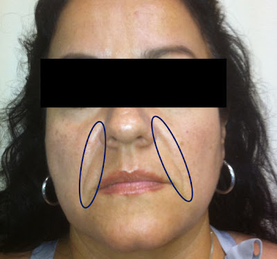 Sharma Facial Plastic Surgery Blog: Nasolabial Fold Injections in Coral ...