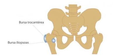Traumatologia - Cirugia de Columna: BURSITIS ISQUIOGLÚTEA