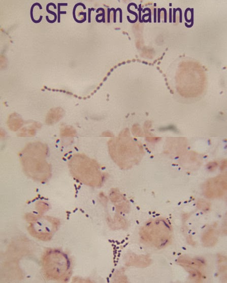 Medical Laboratory and Biomedical Science: CSF Gram Staining Case ...