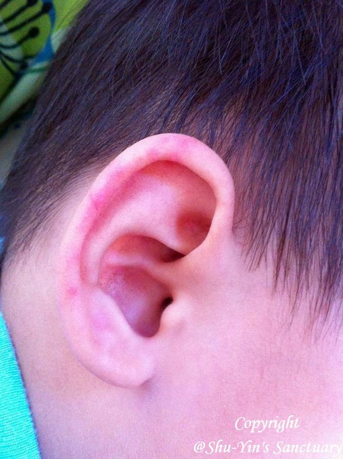 Shu-Yin's Sanctuary: HFMD