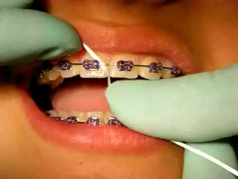 Bales Orthodontics: How to floss with Braces