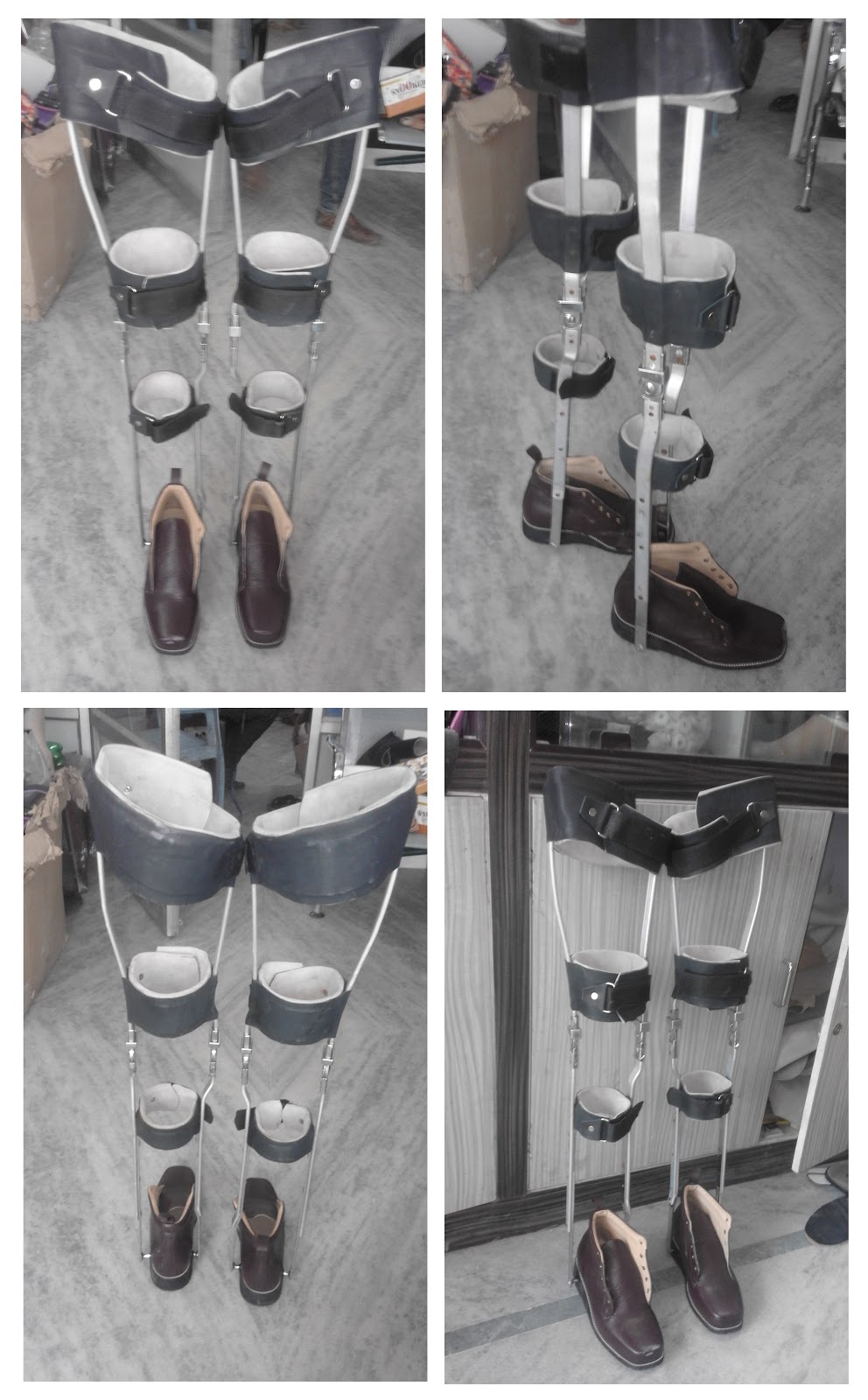 Prosthetics & Orthotics from My Care: Calipers for Polio Patients (KAFO)