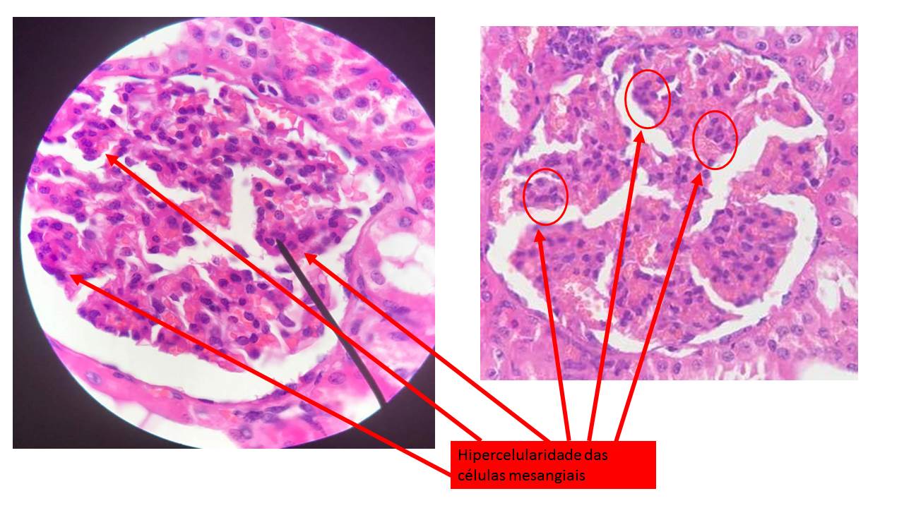 HISTOLOGIA90: RIM NORMAL E GLOMERULONEFRITES