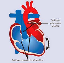Dunlap Family Journey: Understanding Double Inlet Left Ventricle (DILV)