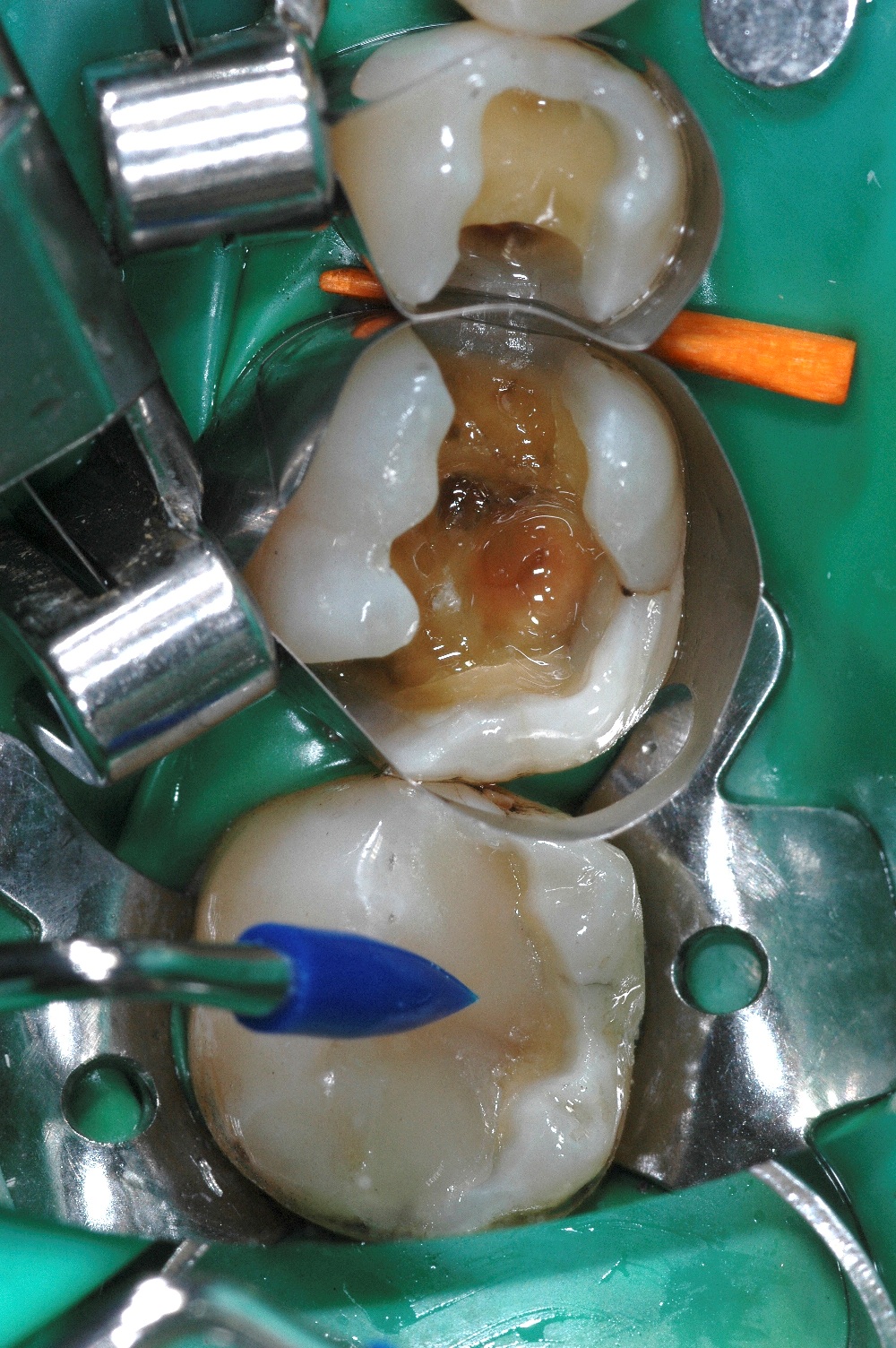 Hai la dentist: Carii dentare