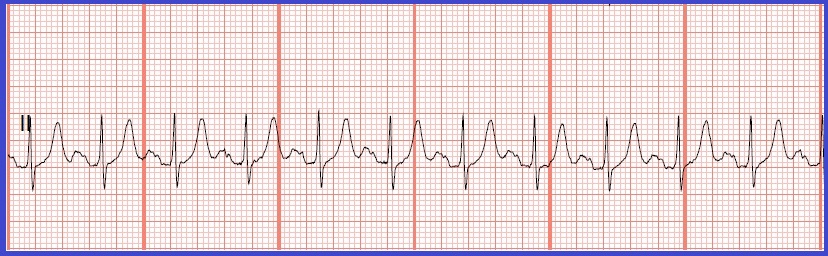 Practice EKG Rhythm Strips 161