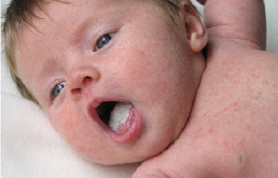 Causas y tratamiento para la candidiasis oral en los bebés - varios ...