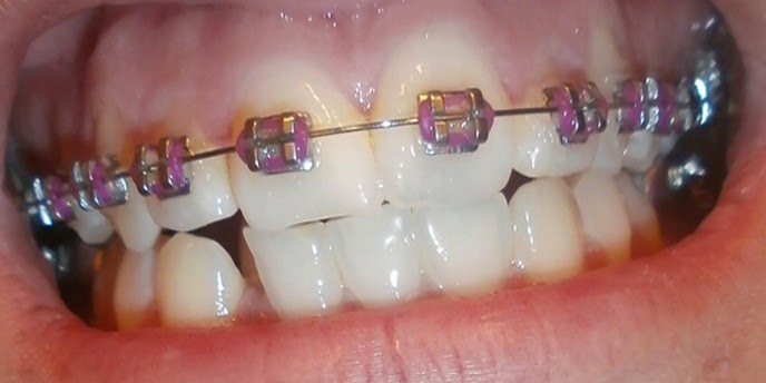 Mis Brackets: Paso a Paso [Mi experiencia]