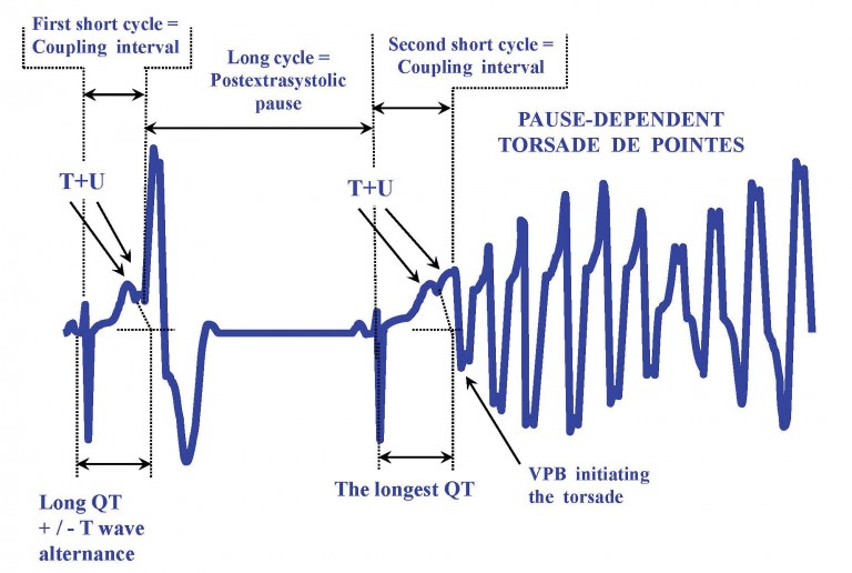 Dr Han Naung @ Henry Han : Electrophysiology and Heart Rhythm : Long QT