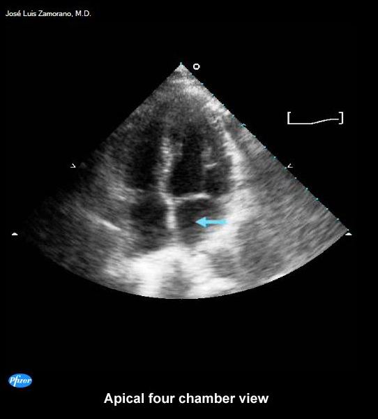 Echocardiography (USG Jantung)