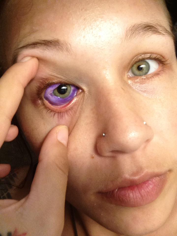 Dafuq!? This woman got purple ink injected into her eye for her sclera ...