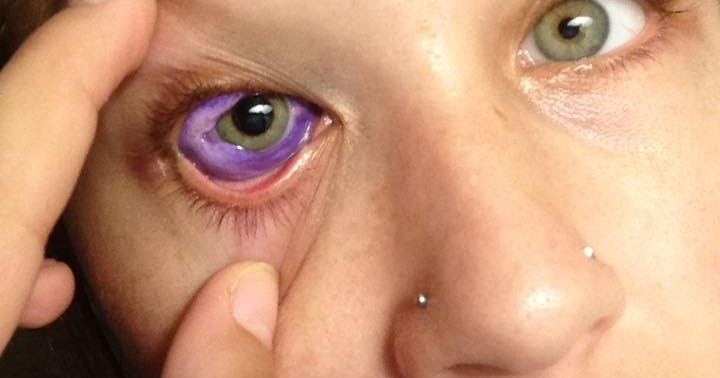 Dafuq!? This woman got purple ink injected into her eye for her sclera ...