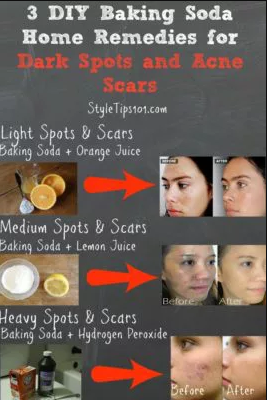 3 DIY BAKING SODA FACE MASKS FOR DARK SPOTS & ACNE SCARS - TOP 5 DIY