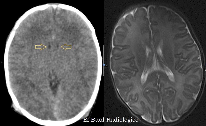 El Baúl Radiológico: 2) EDEMA CITOTÓXICO EN EL SISTEMA NERVIOSO CENTRAL ...
