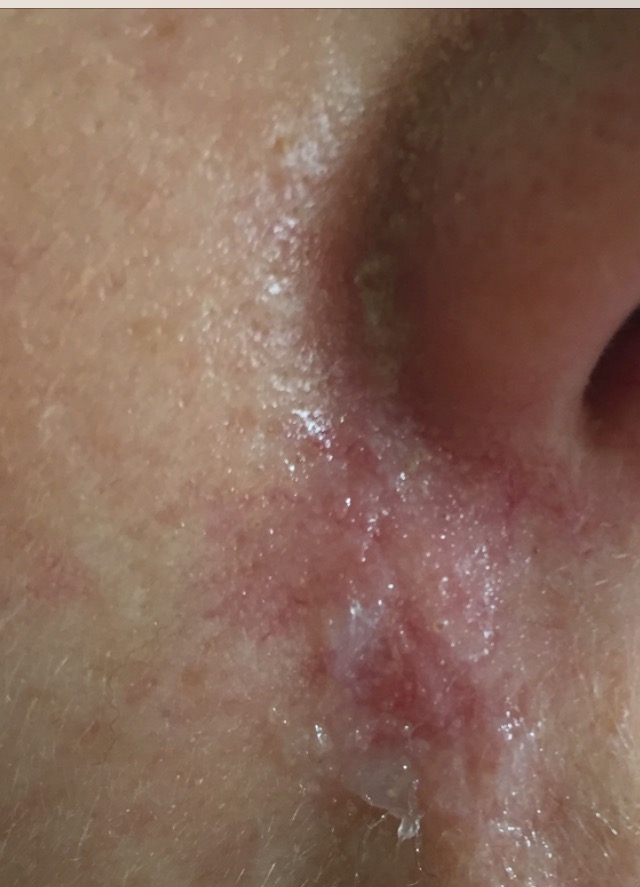 BraveFace . Diary of a facial basal cell carcinoma ( bcc): 3 Weeks Post Op