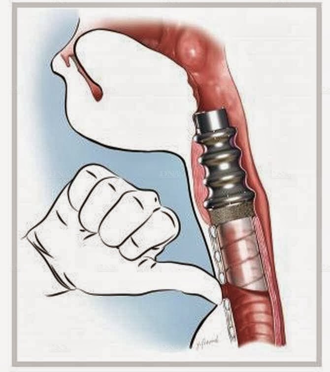 First Implantation of Human Artificial Larynx Announced! | Fauquier ENT ...