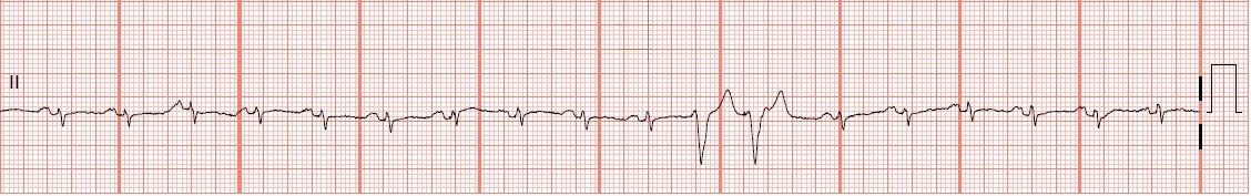 EKG Rhythm Strip Quiz 19