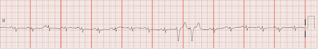 EKG Rhythm Strip Quiz 19